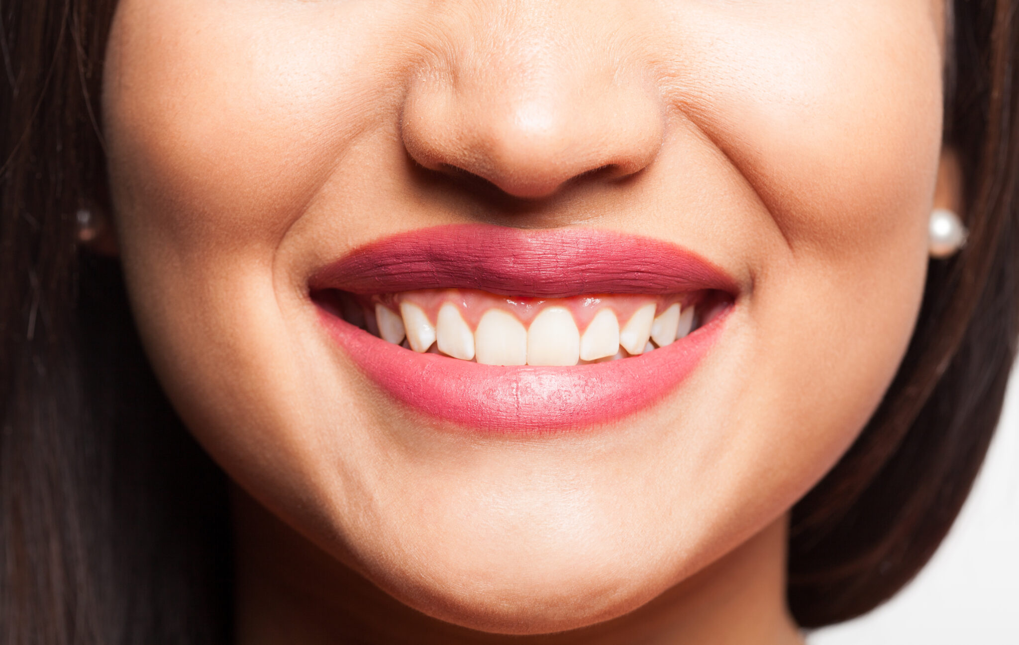 White Spots on Teeth After Braces - Thurman Orthodontics